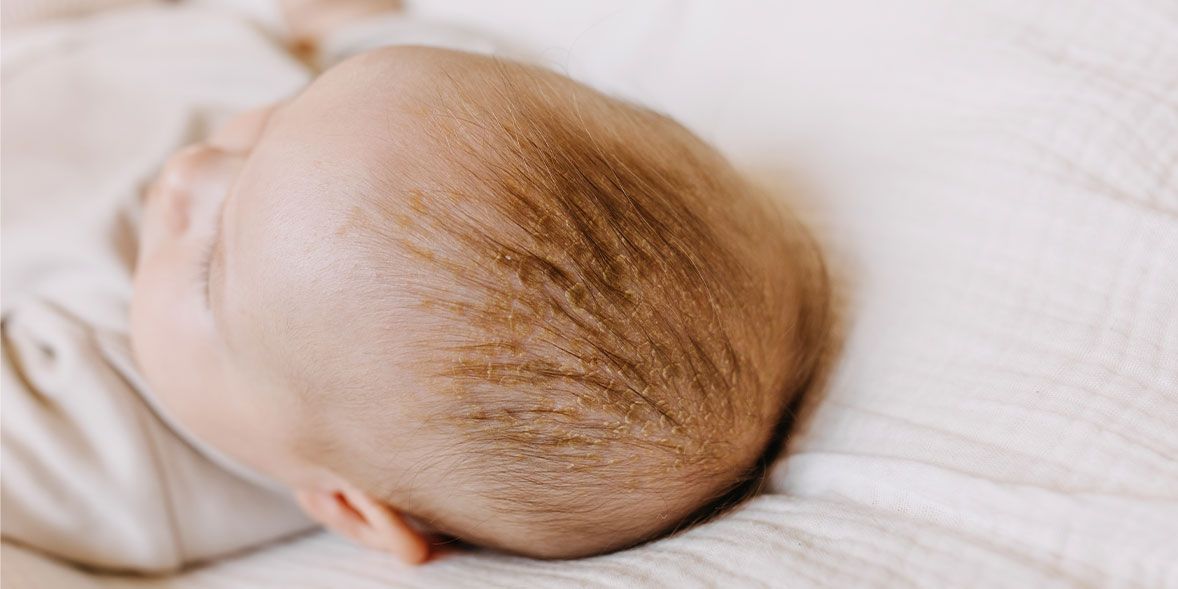 Common Childhood Skin Rashes With Pictures: What Rash Is This? - Which?