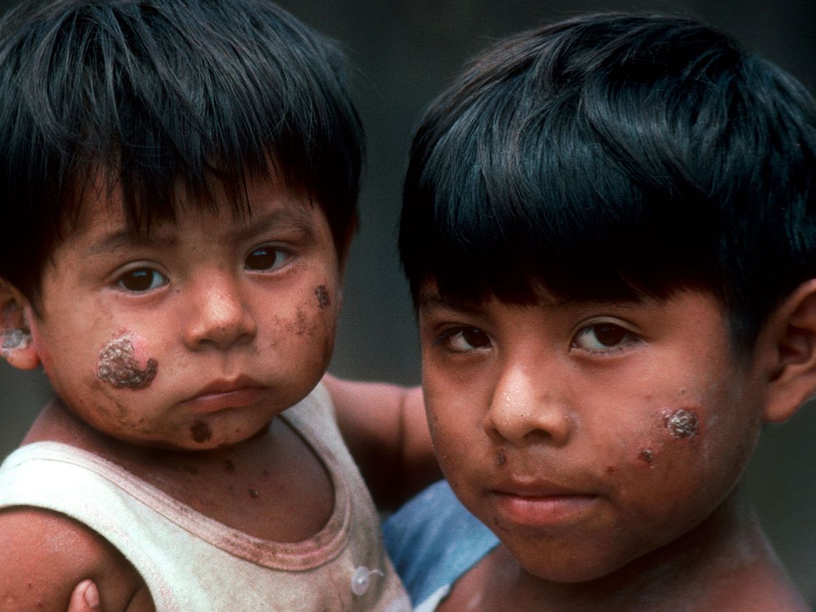 Common Childhood Skin Rashes With Pictures: What Rash Is This? - Which?