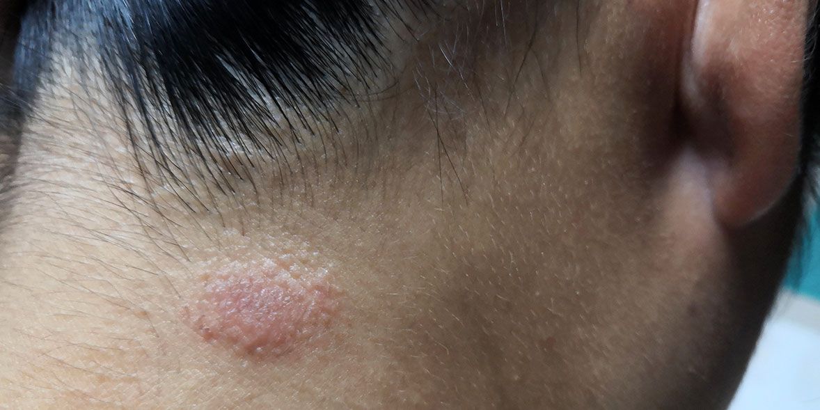 Common Childhood Skin Rashes With Pictures: What Rash Is This? - Which?