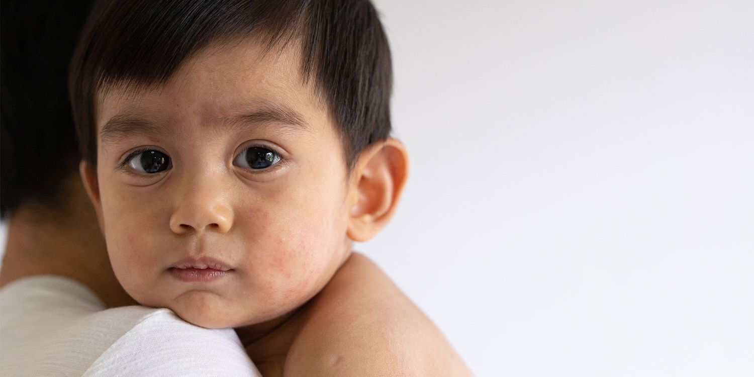 Common childhood skin rashes with pictures: what rash is this? - Which?