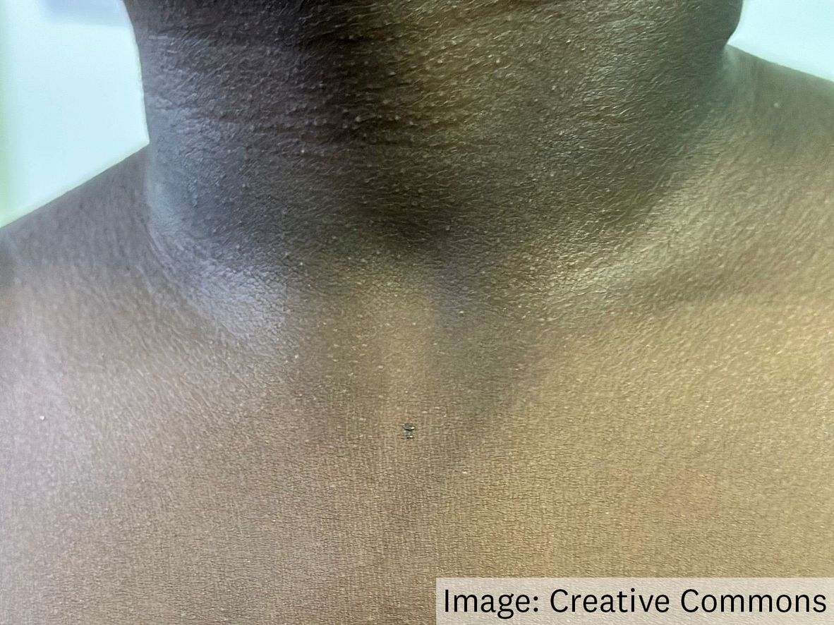 Common Childhood Skin Rashes With Pictures: What Rash Is This? - Which?